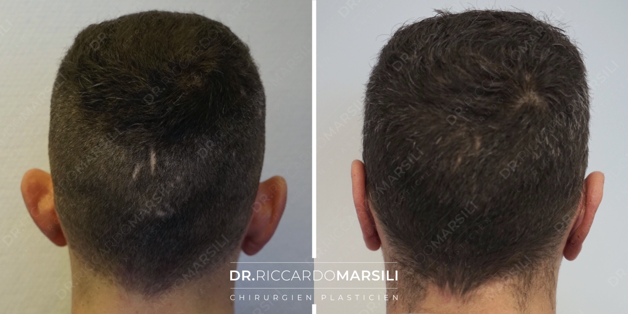 Earfold Opération des oreilles décollées Paris, otoplastie